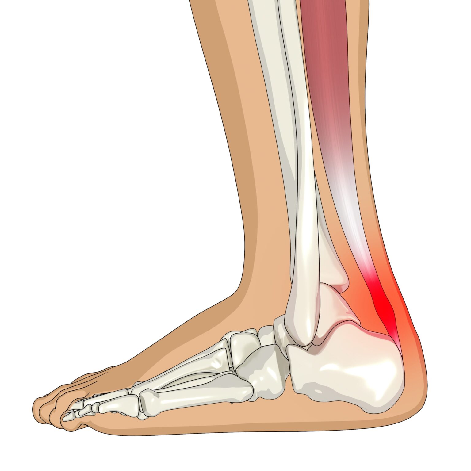ACHILLES TENDINITIS - Aaziban