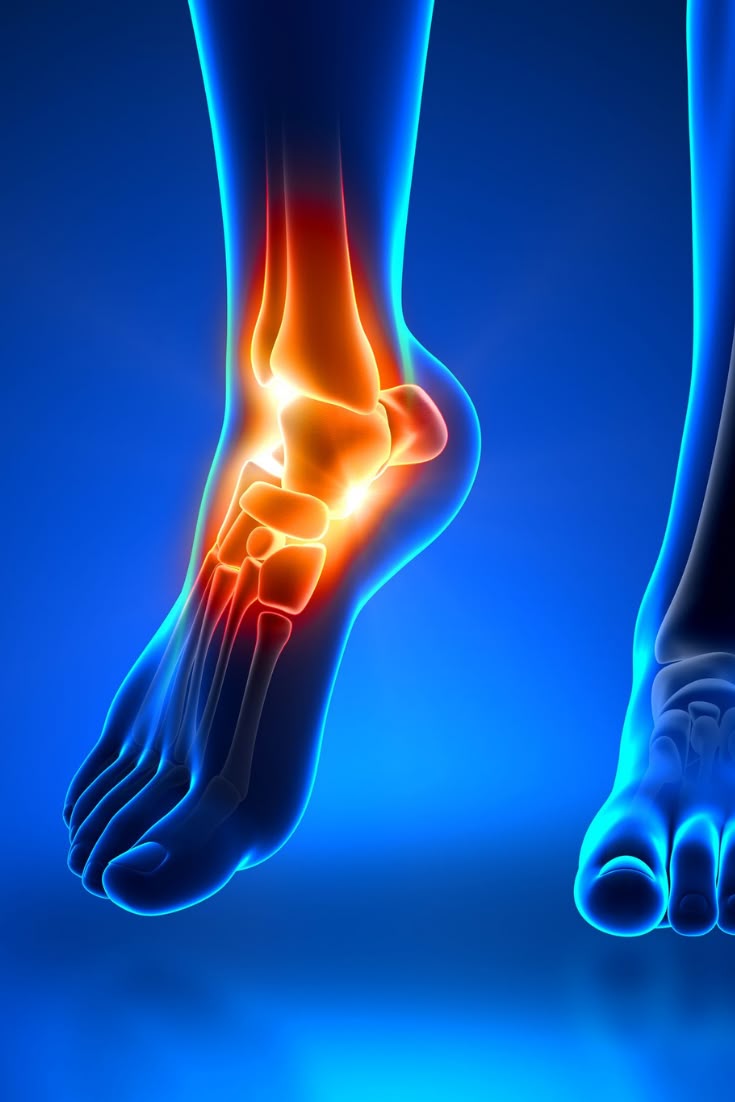 Calcaneal Bursitis – Understanding Heel Pain and Its Treatment - Aaziban